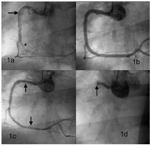 Spontaneous Coronary Artery Dissection. An Infrequent Cause of Acute ...