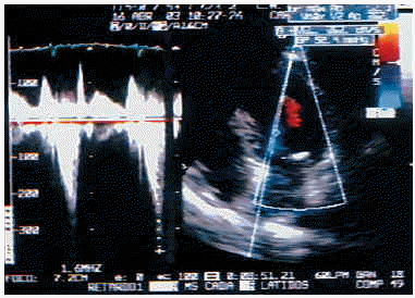 Transient Left Ventricular Apical Ballooning Without Coronary Stenoses ...