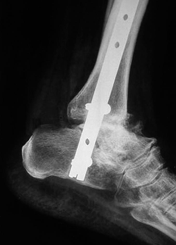 Artrodesis tibiotalocalcánea con clavo retrógrado de reconstrucción ...