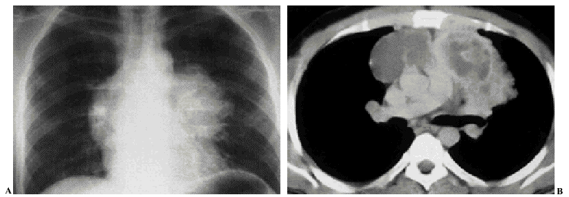 Quiste tímico multilocular idiopático: presentación de cuatro casos en ...