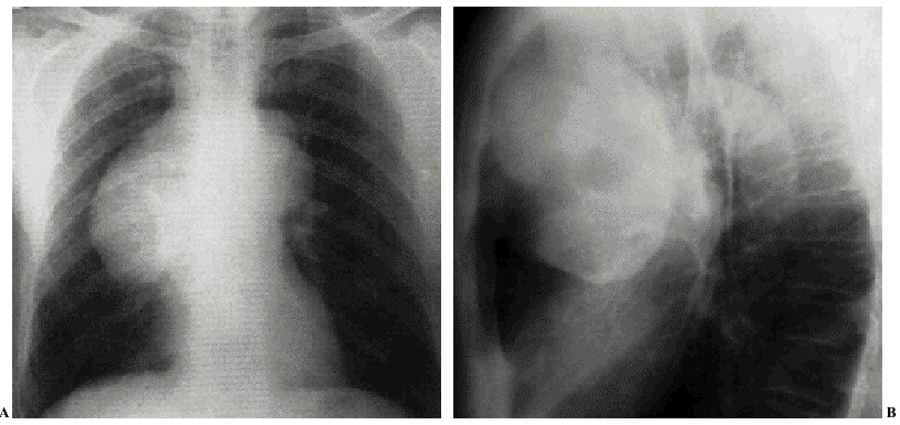 Quiste tímico multilocular idiopático: presentación de cuatro casos en ...