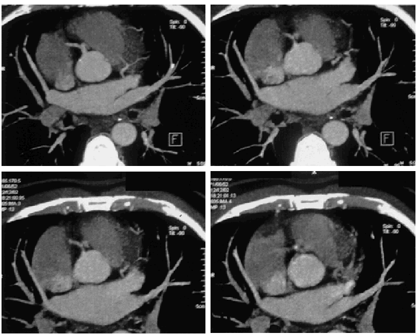 Estudio de las arterias coronarias mediante tomografía computarizada ...