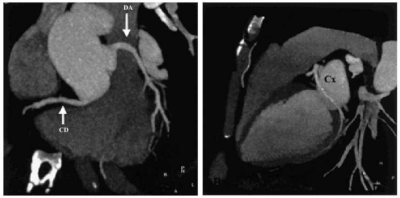Estudio de las arterias coronarias mediante tomografía computarizada ...