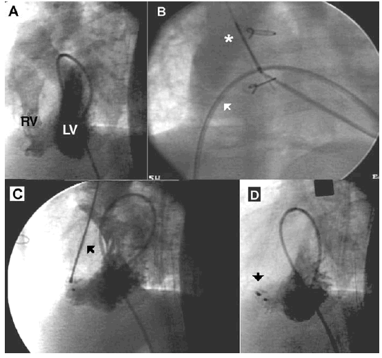 Percutaneous Closure of Ventricular Septal Defect With an Amplatzer ...