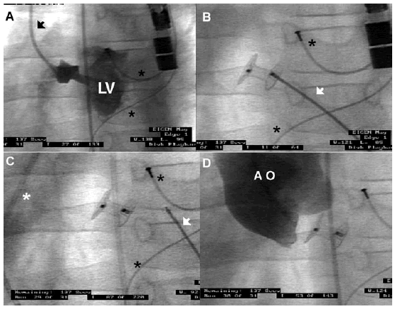 Percutaneous Closure of Ventricular Septal Defect With an Amplatzer ...