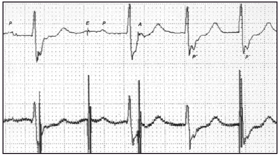 Atrial Pacing