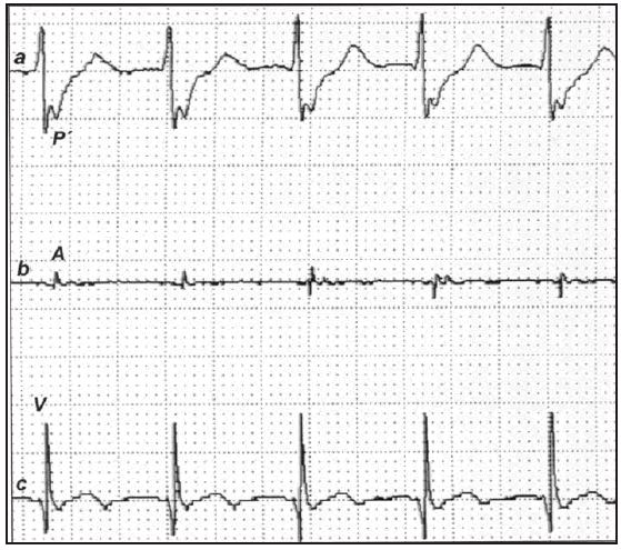 Atrial Pacing