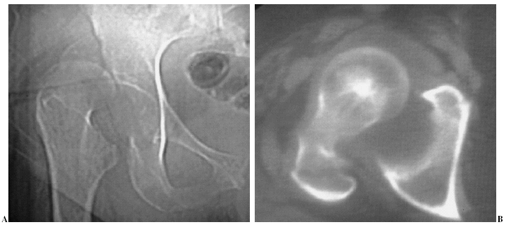 Luxación traumática anterior y superior recidivante de cadera. A ...