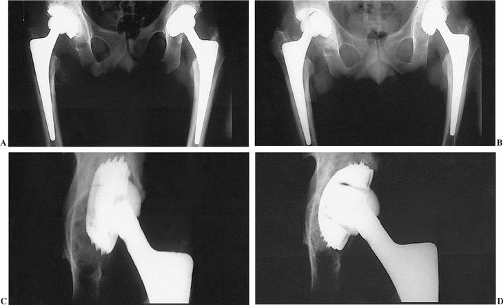 Seguimiento evolutivo de las artroplastias de cadera en pacientes con ...
