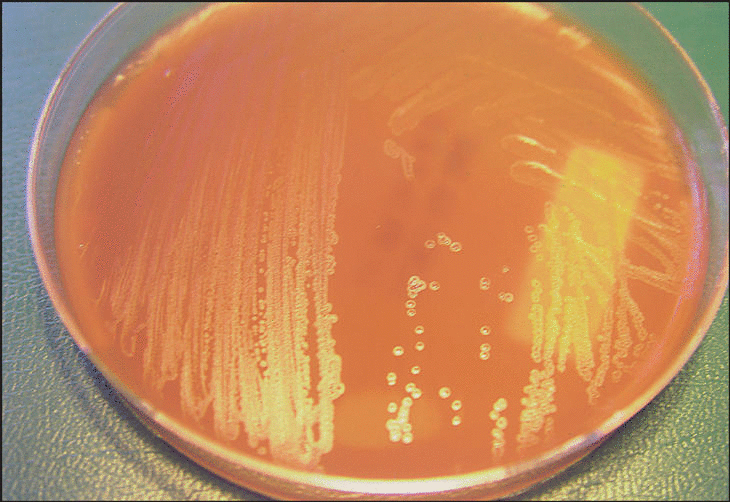 Niña con fiebre, tumefacción y procidencia velopalatina unilateral ...