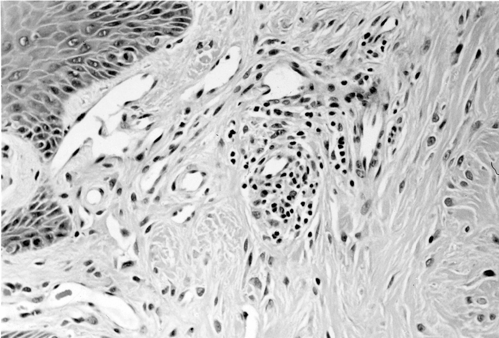 Poliartritis y nódulos cutáneos. ¿Primer caso de reumatismo ...