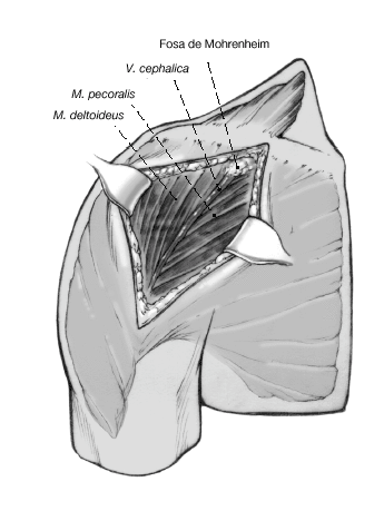 Hemiartroplastia en fracturas de la cabeza humeral | Técnicas ...