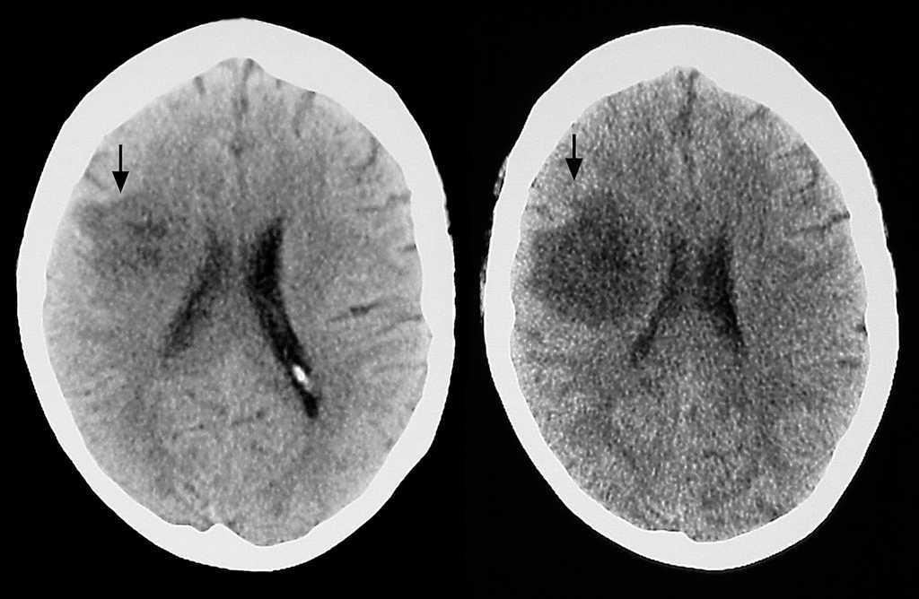 Absceso cerebral en paciente inmunodeprimida | Enfermedades Infecciosas ...
