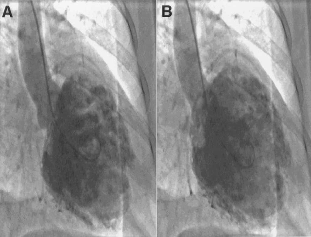 Noncompaction of the Ventricular Myocardium | Revista Española de ...