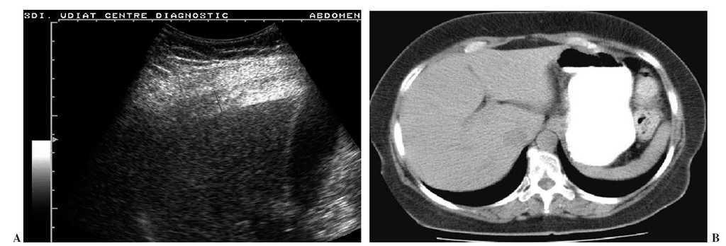 Punción biopsia hepática ambulatoria (PBHA) guiada por ultrasonografía ...