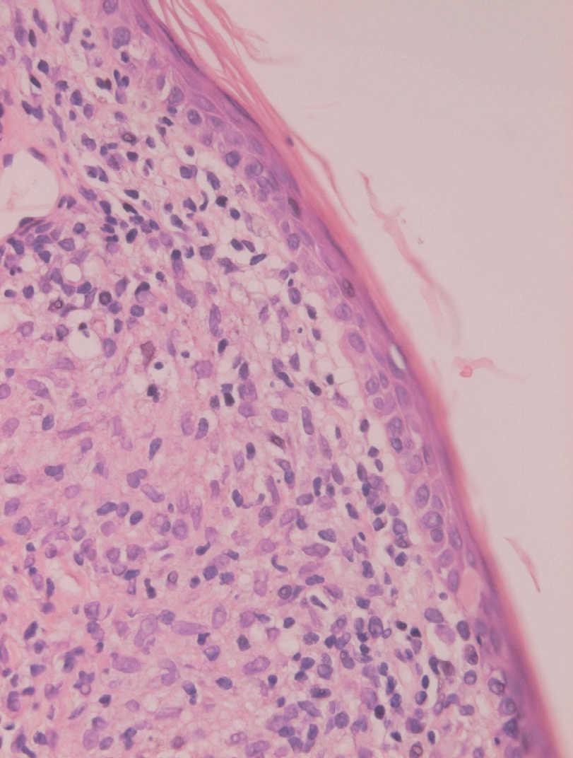 Leishmaniasis cutánea | Actas Dermo-Sifiliográficas