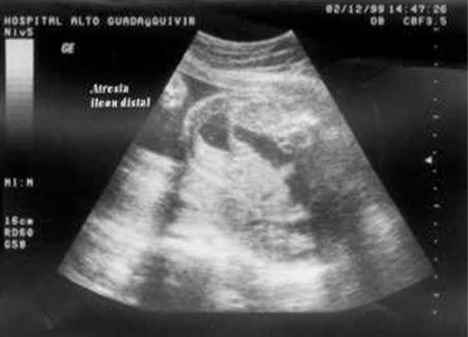 Atresia de íleon distal: diagnóstico prenatal ecográfico | Clínica e ...
