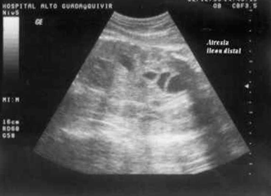 Atresia de íleon distal: diagnóstico prenatal ecográfico | Clínica e ...