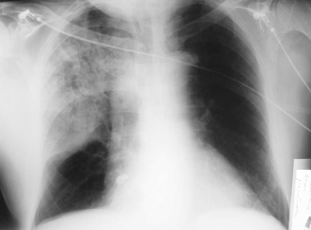 Spontaneous Pneumopericardium in a Patient With Community-Acquired ...