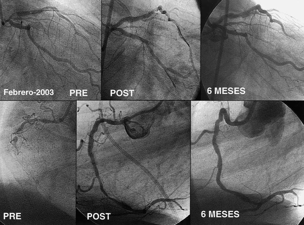 Intervencionismo percutáneo. ¿Dónde estamos y adónde vamos? | Revista ...