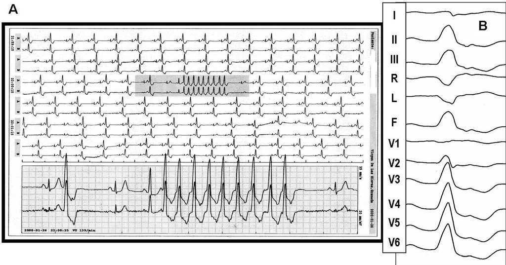 Disfunción ventricular izquierda inducida por arritmias ventriculares ...