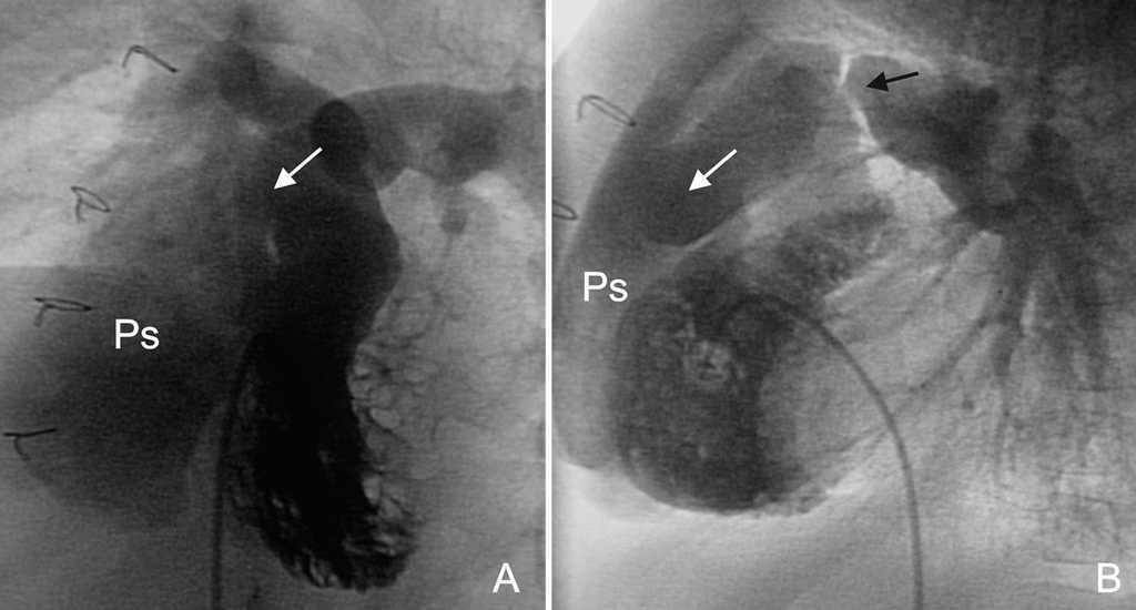 Postsurgical Pseudoaneurysm of the Right Ventricular Outflow Tract ...