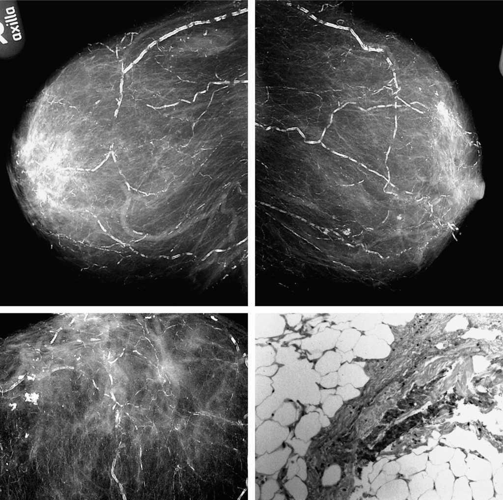 Calcificaciones mamarias en pacientes tratadas con hemodiálisis ...
