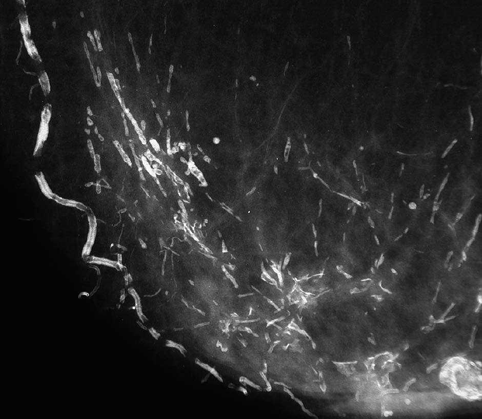 Calcificaciones mamarias en pacientes tratadas con hemodiálisis ...