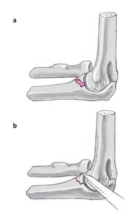 Tratamiento quirúrgico de las luxaciones del codo asociadas a fractura ...