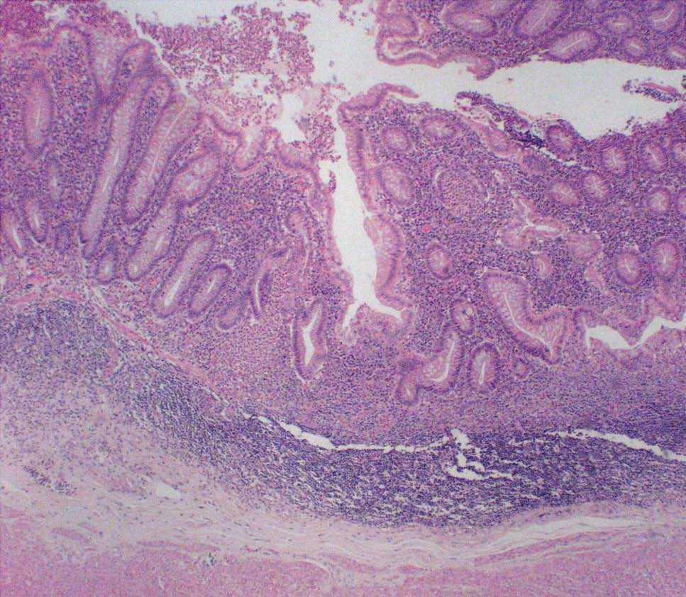 Infección cecal por citomegalovirus en paciente apendicectomizado con ...