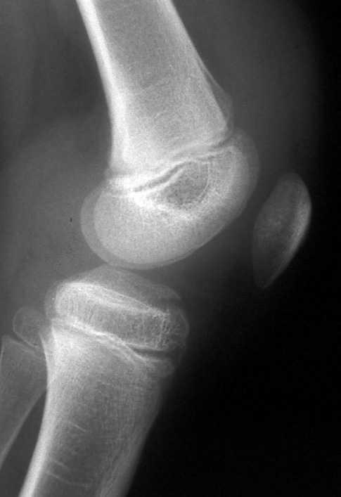 Fijación interna de avulsión de espina tibial en niños | Técnicas ...