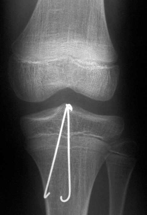 Fijación interna de avulsión de espina tibial en niños | Técnicas ...