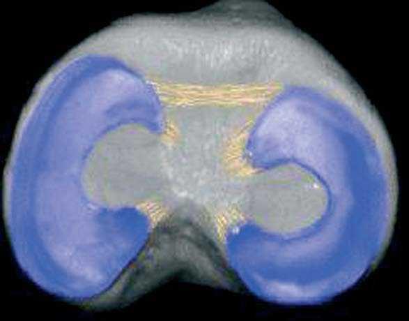 Fijación interna de avulsión de espina tibial en niños | Técnicas ...