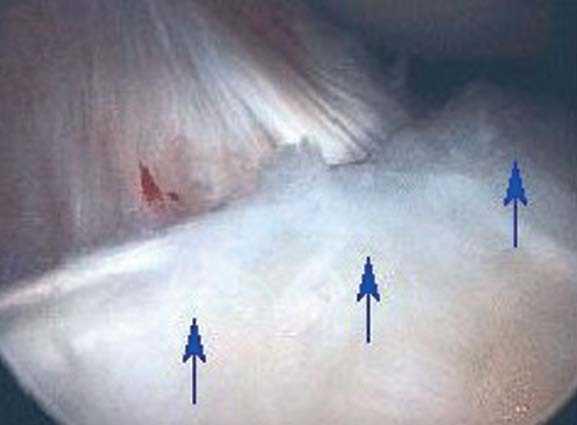 Fijación interna de avulsión de espina tibial en niños | Técnicas ...