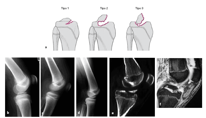 Fijación interna de avulsión de espina tibial en niños | Técnicas ...