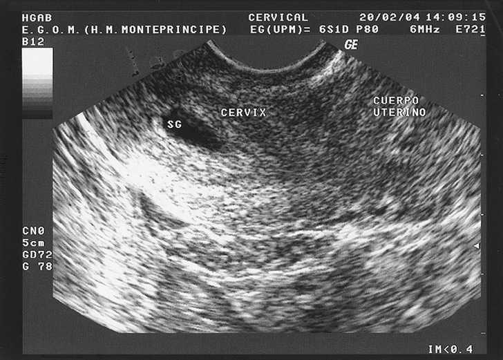 Embarazo ectópico cervical. Tratamiento médico conservador | Progresos ...