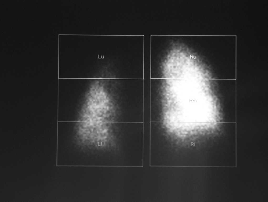 Asymmetric Pulmonary Perfusion Causing Unilateral Pulmonary Edema As a ...