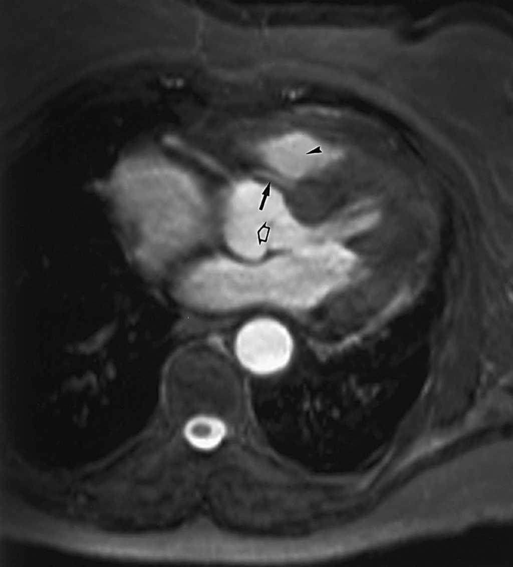 Valor de la coronariografía por resonancia magnética en el diagnóstico ...