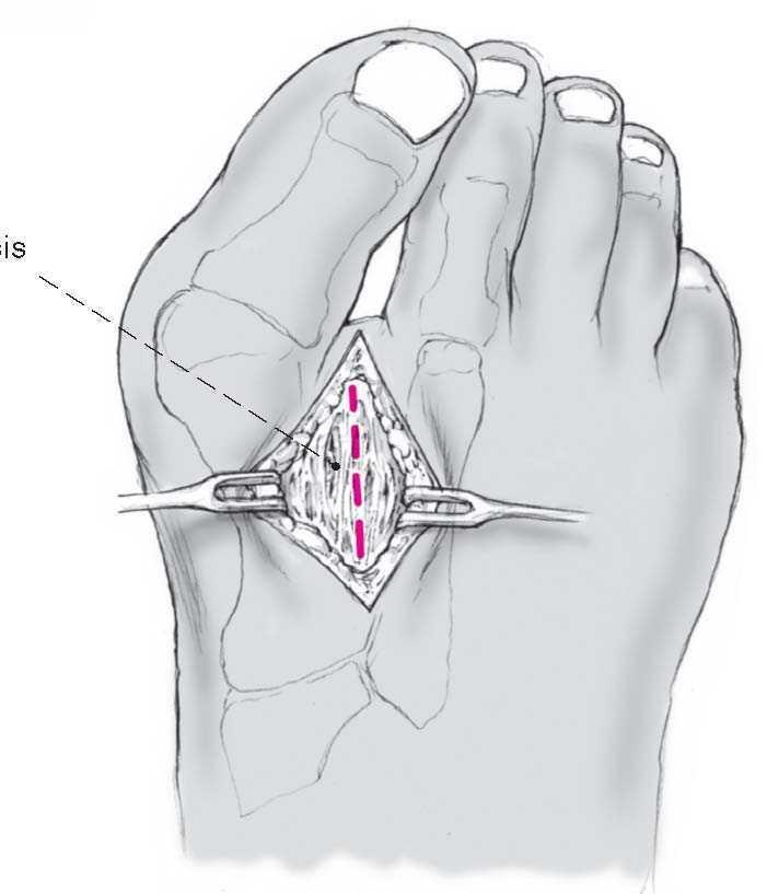 Osteotomía de Ludloff para la corrección del hallux valgus | Técnicas ...