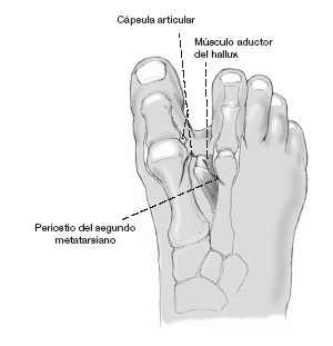 Osteotomía de Ludloff para la corrección del hallux valgus | Técnicas ...