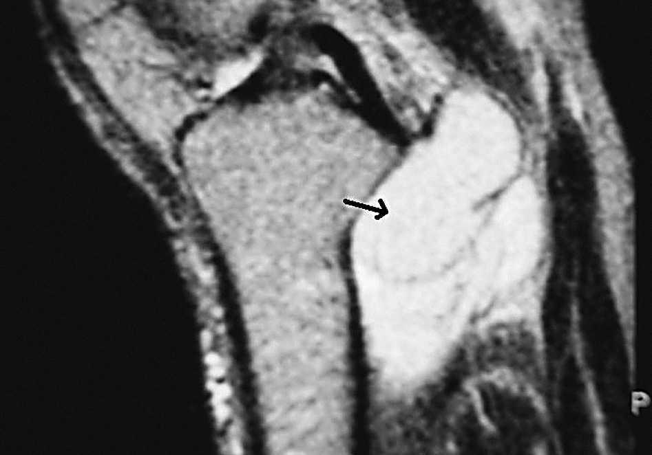 Pseudotrombosis venosa profunda de miembro inferior secundaria a quiste ...