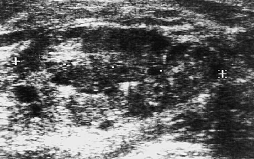 Fibroadenomas de mama con atipia o carcinoma en su interior ...