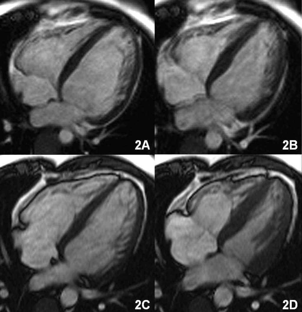 Evidencia por resonancia magnética de la eficacia del tratamiento ...