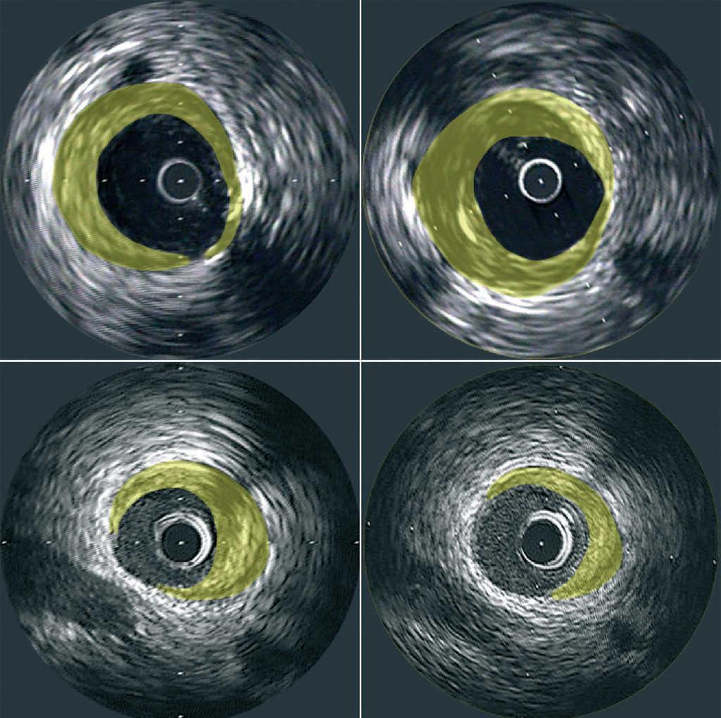 Assessment of Progression and Regression of Coronary Atherosclerosis by ...