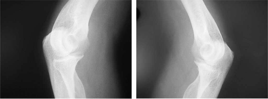 Avulsión concomitante de tríceps braquial bilateral y tendón rotuliano ...