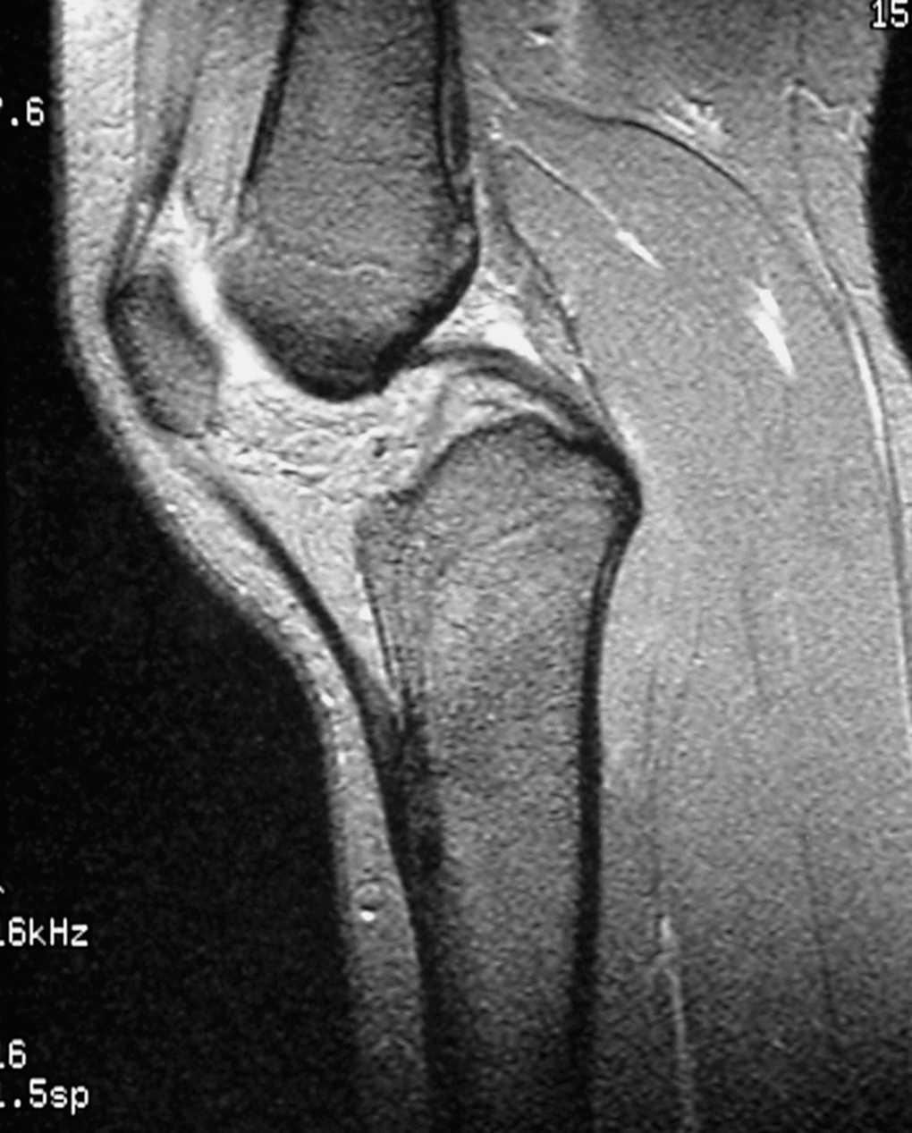 Epifisiodesis tibial proximal con genu recurvatum | Revista de la ...