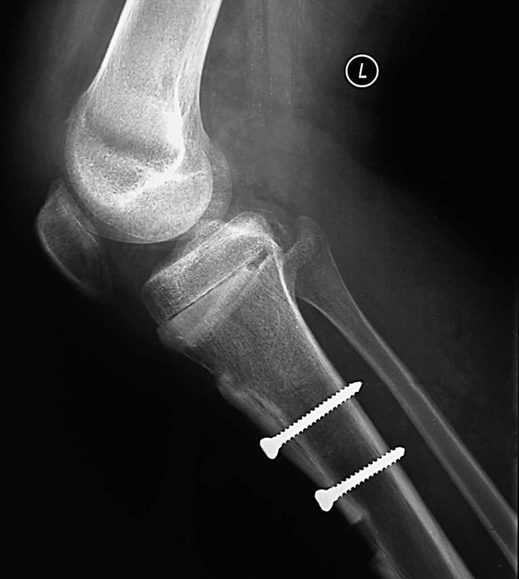 Epifisiodesis tibial proximal con genu recurvatum | Revista de la ...