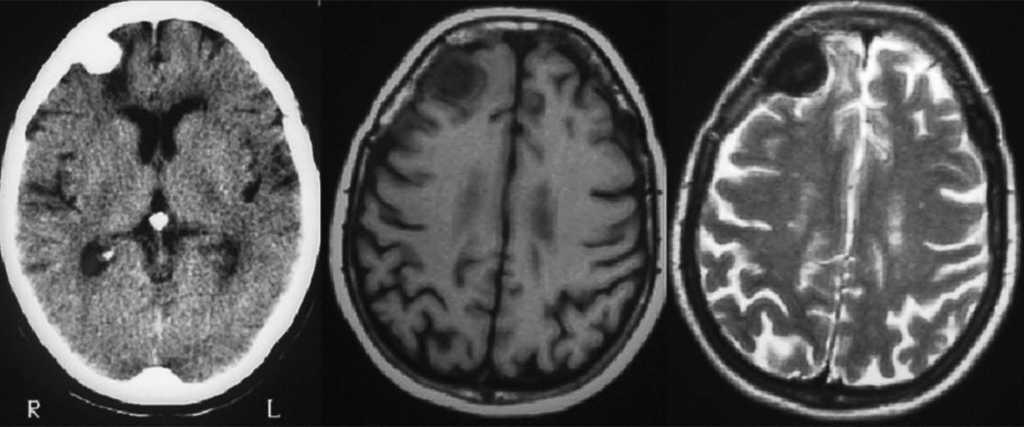 Calcificaciones intracraneales. Imagen por RM | Radiología