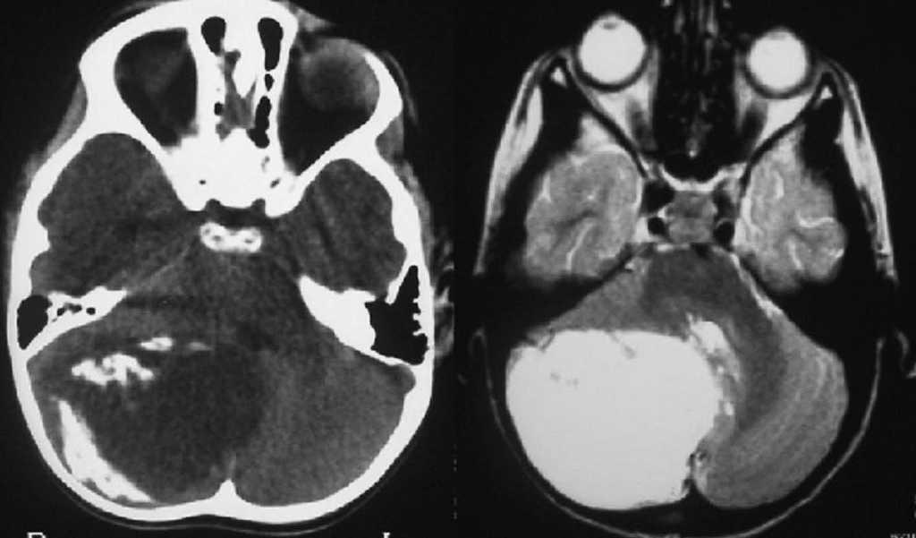 Calcificaciones intracraneales. Imagen por RM | Radiología