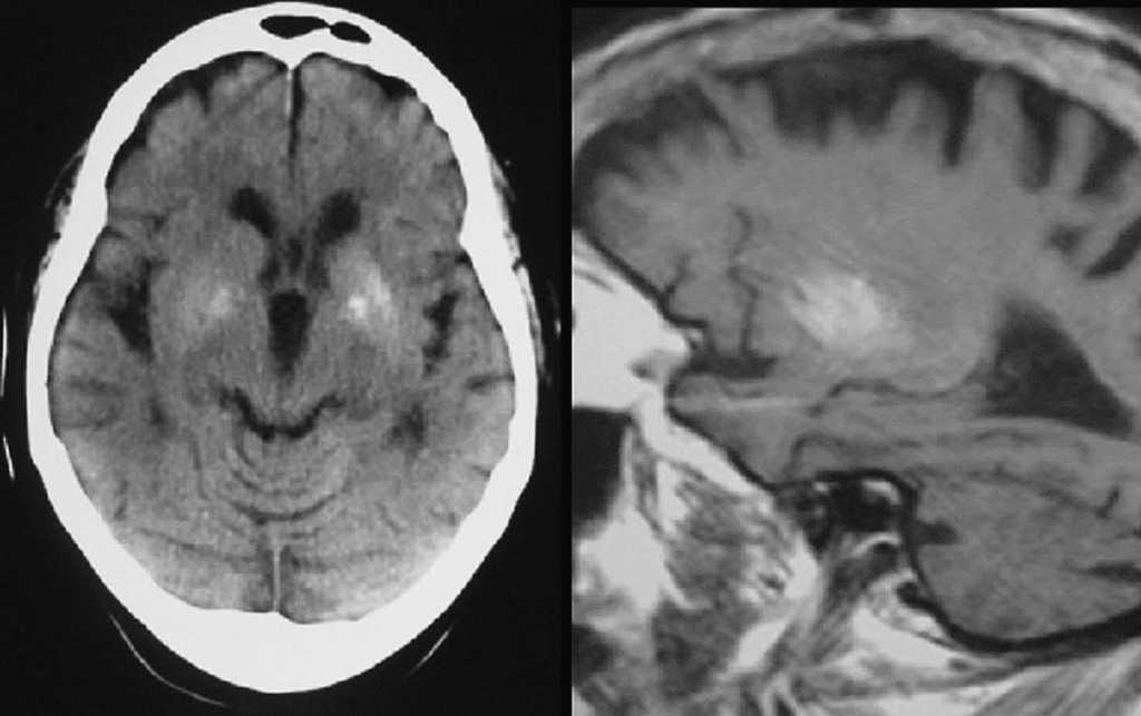 Calcificaciones intracraneales. Imagen por RM | Radiología